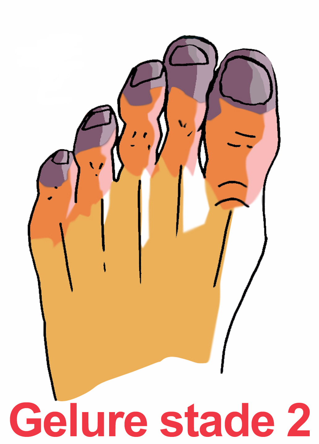 Gelures (rando, trek, montagne) : symptômes, traitement, définition ...