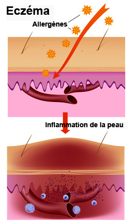 Eczéma de l'enfant : symptômes, traitement, définition