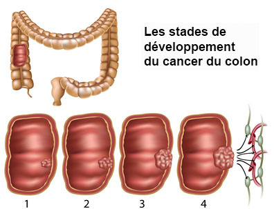 Cancer du colon, cancer colorectal : symptômes, traitement, définition ...
