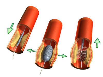 Angioplastie : définition, technique - docteurclic.com