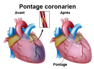 Pontage coronarien : définition, technique - docteurclic.com