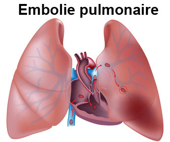 Embolie pulmonaire : symptômes, traitement, définition - docteurclic.com