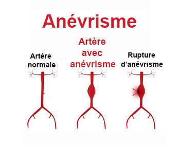 Anévrisme artériel : symptômes, traitement, définition - docteurclic.com