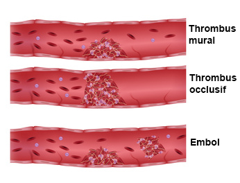 Embol : définition - docteurclic.com