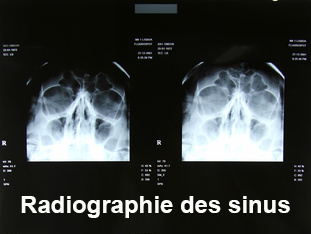Radiographies des sinus examen - docteurclic.com