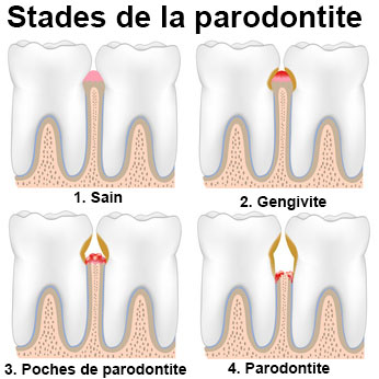 Parodontite : symptômes, traitement, définition - docteurclic.com