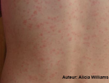 Exanthème : définition - docteurclic.com