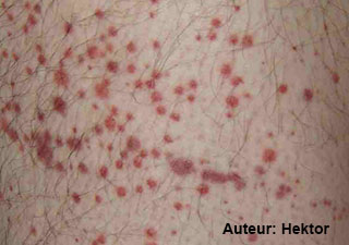 Purpura : symptômes, traitement, définition - docteurclic.com