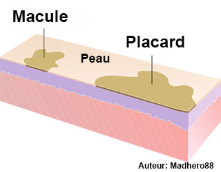 Macules et placards : définition - docteurclic.com