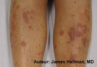 Lichen plan : symptômes, traitement, définition - docteurclic.com