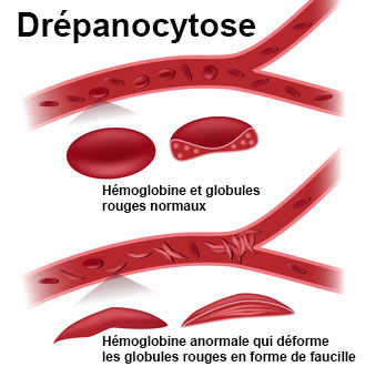 Drépanocytose : symptômes, traitement, définition - docteurclic.com