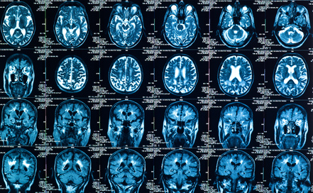 Scanner cérébral examen - docteurclic.com