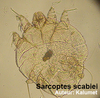 Gale : symptômes, traitement, définition - docteurclic.com