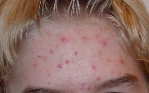 Acné : quand et comment la traiter ? : symptômes, traitement ...