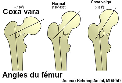 Coxa vara : symptômes, traitement, définition - docteurclic.com