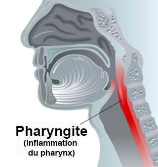 Pharyngite de l'enfant : symptômes, traitement, définition ...