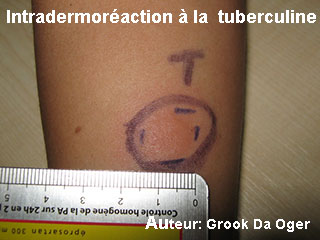 Test à la tuberculine examen - docteurclic.com