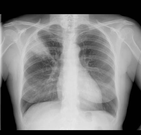 Fracture de côte (rando, trek, montagne) : symptômes, traitement ...
