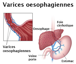 Varices oesophagiennes : symptômes, traitement, définition - docteurclic.com