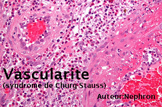 Vascularites : définition - docteurclic.com
