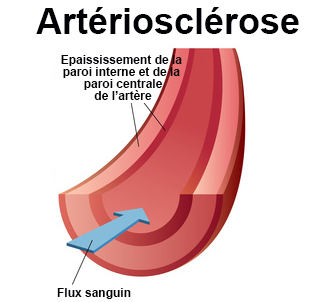 Artériosclérose : symptômes, traitement, définition - docteurclic.com