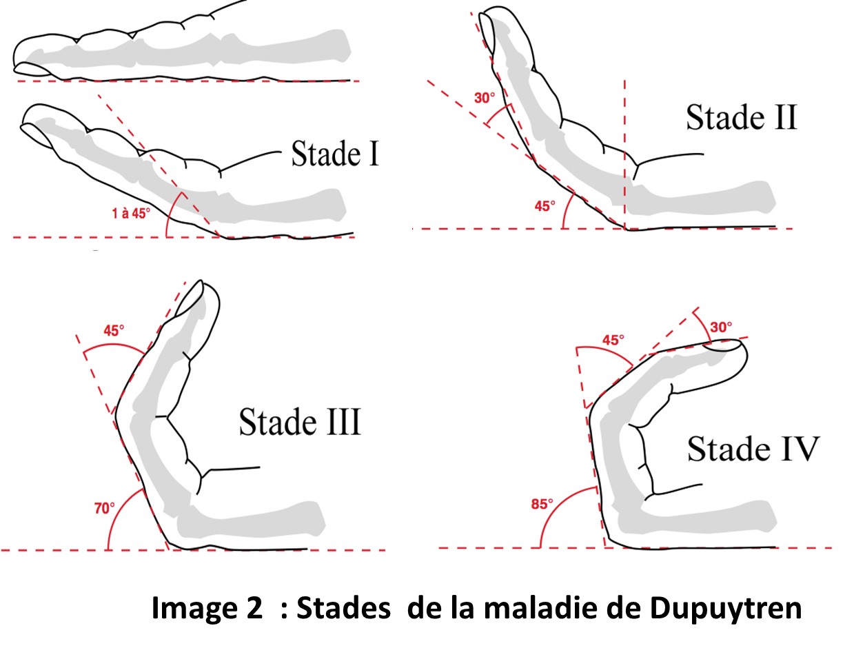 Chirurgie de la maladie de Dupuytren : définition - docteurclic.com