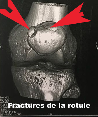 Fracture du genou : symptômes, traitement, définition - docteurclic.com